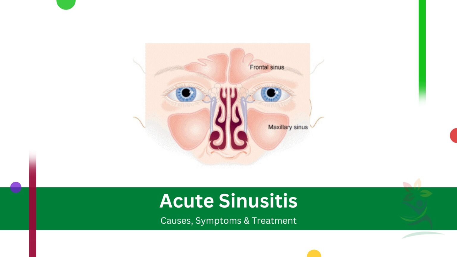 Acute Sinusitis | Symptoms, Causes, and Treatment Guide